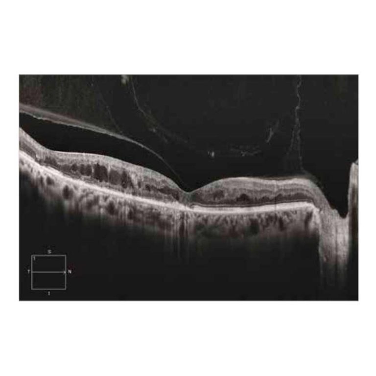 Zeiss HD-OCT Cirrus 5000 - For Retinal Disease - Medilex