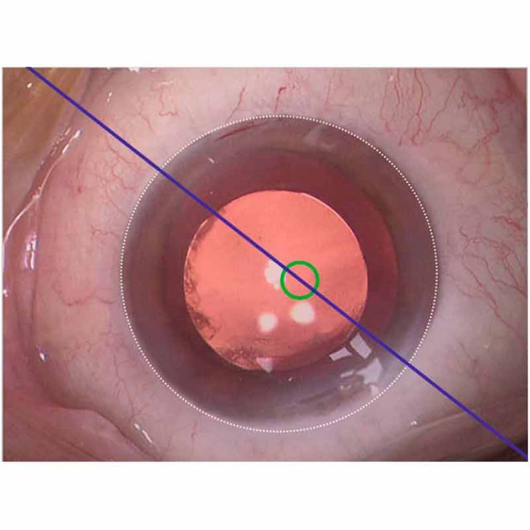 CALLISTO Eye - Computer assisted cataract surgery