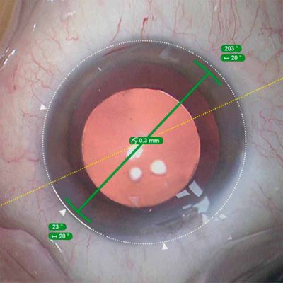 CALLISTO Eye - Computer assisted cataract surgery