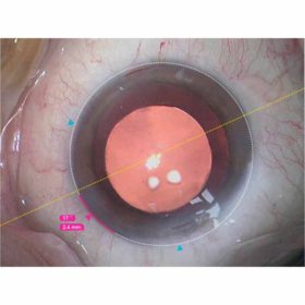 CALLISTO Eye - Computer assisted cataract surgery