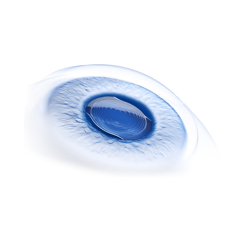 ZEISS Cataract Workflow - Medilex